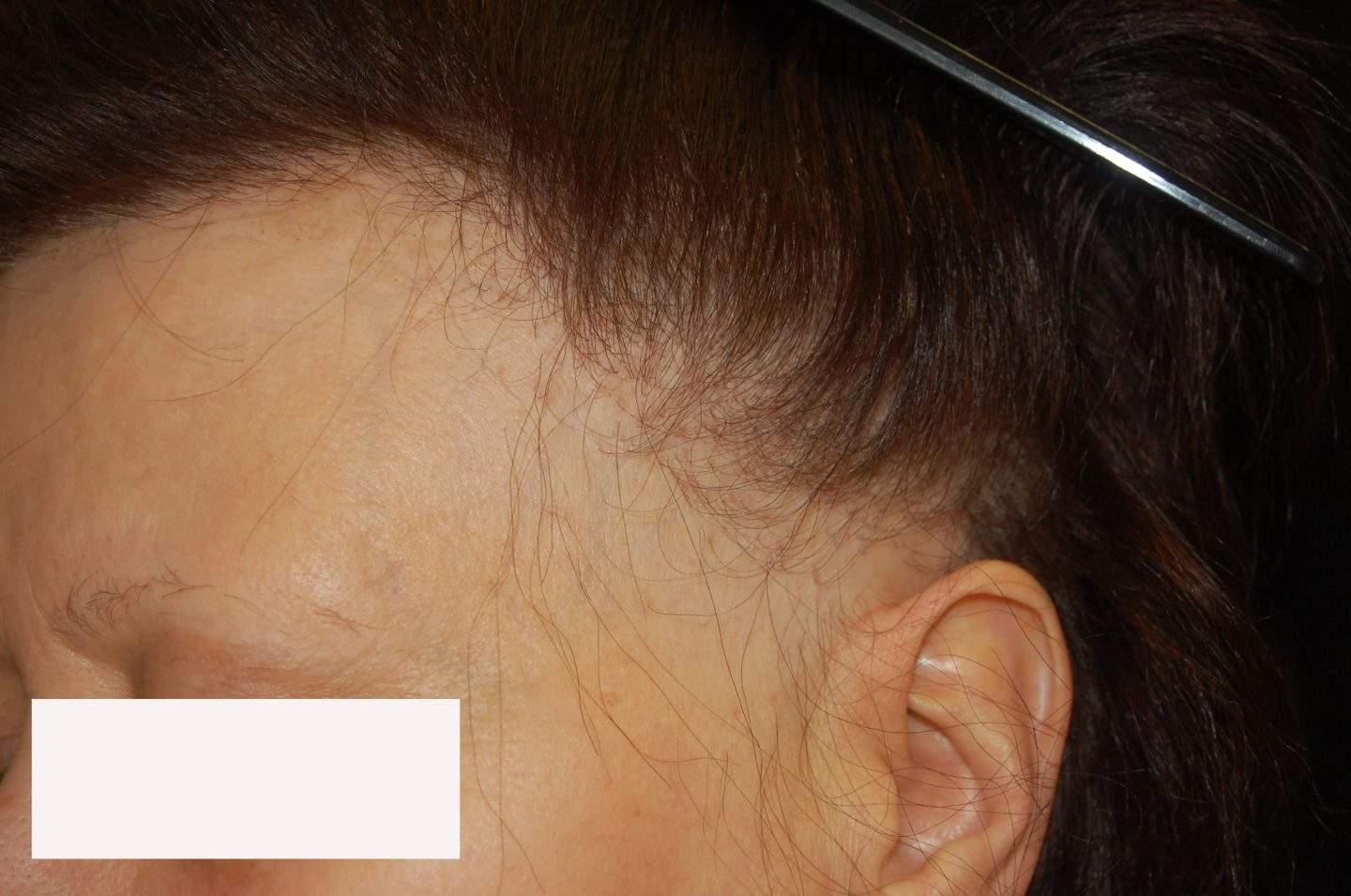 Alopecia fibrosante frontale: malattia sempre più frequente